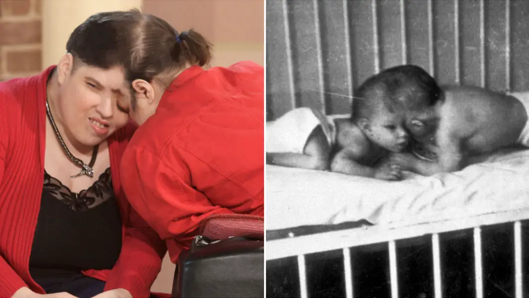 The world's oldest conjoined twins, Lori and George Schappell, die at ...
