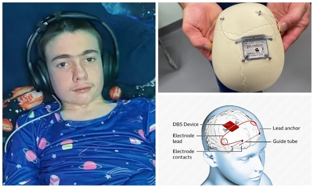 World’s first epilepsy device implanted in UK teenager’s skull ...