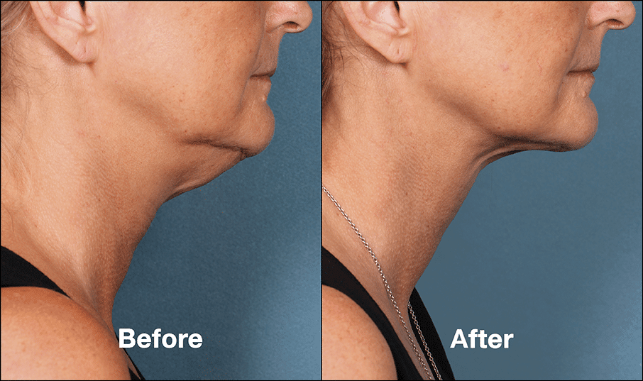 What Is Kybella? The Face-Slimming Procedure With a Painful Healing ...