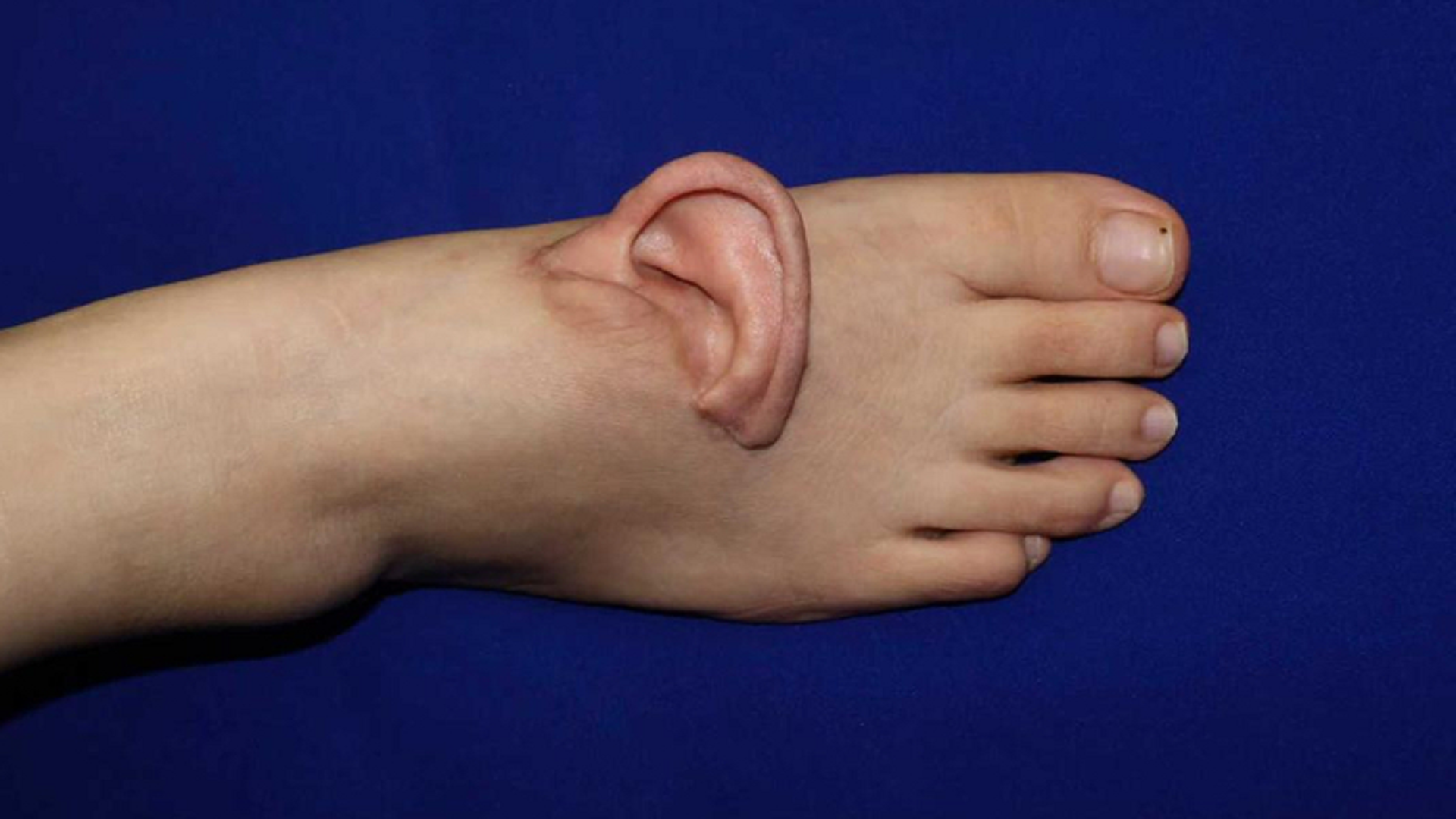 Chinese Surgeons Graft Severed Ear to Patient’s Foot, Reattach It ...